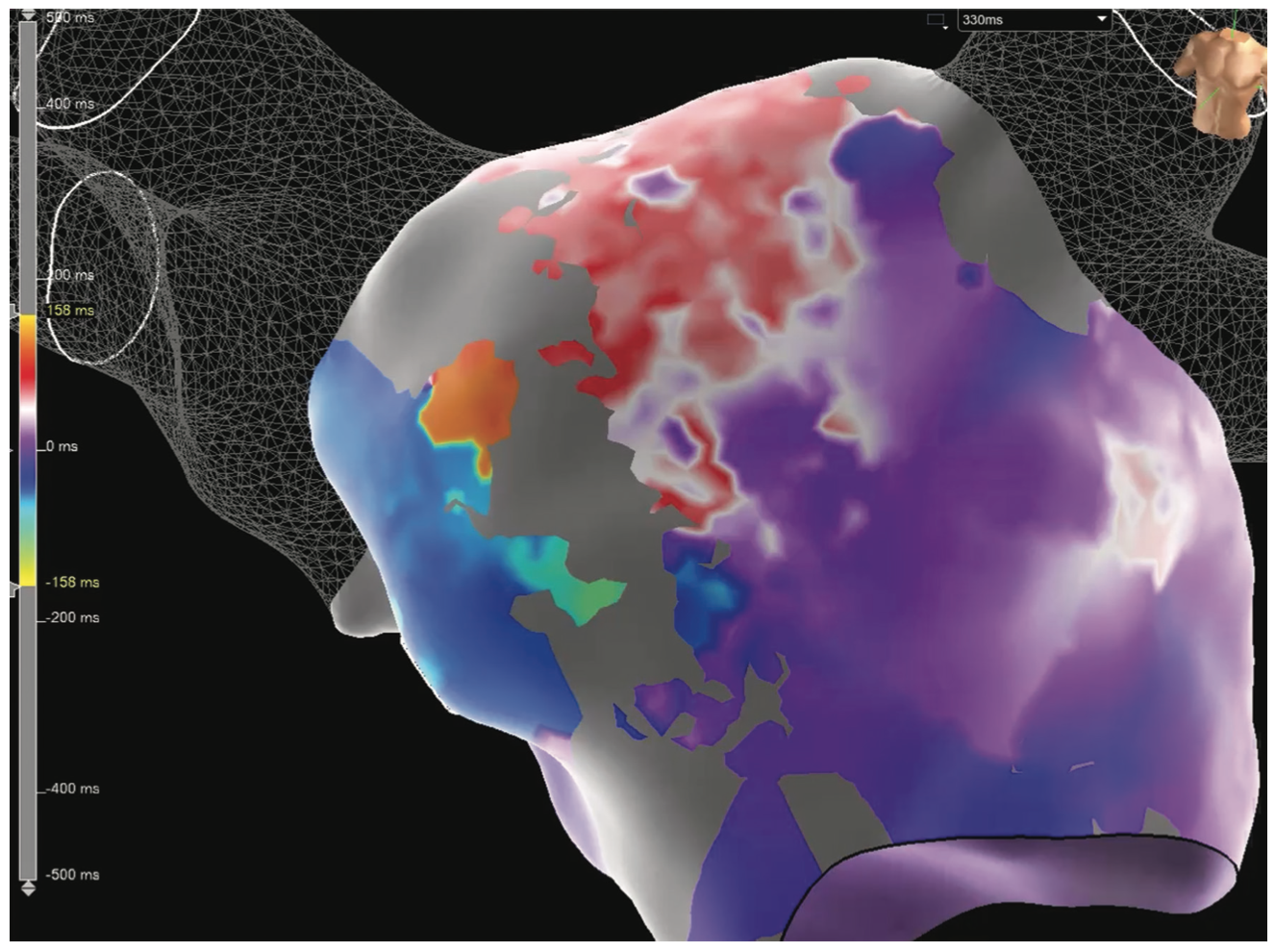 Novel High Density Mapping Techniques For Atypical Atrial Flutter